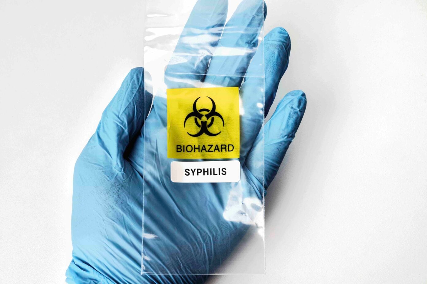 Syphilis and Other Sexually Transmitted Infections Hit Record Levels in ...